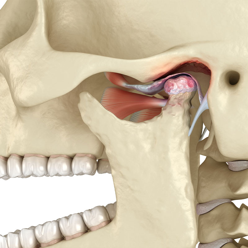 TMJ Treatment - Bel Air MD Dentist | Harford County MD Dentist